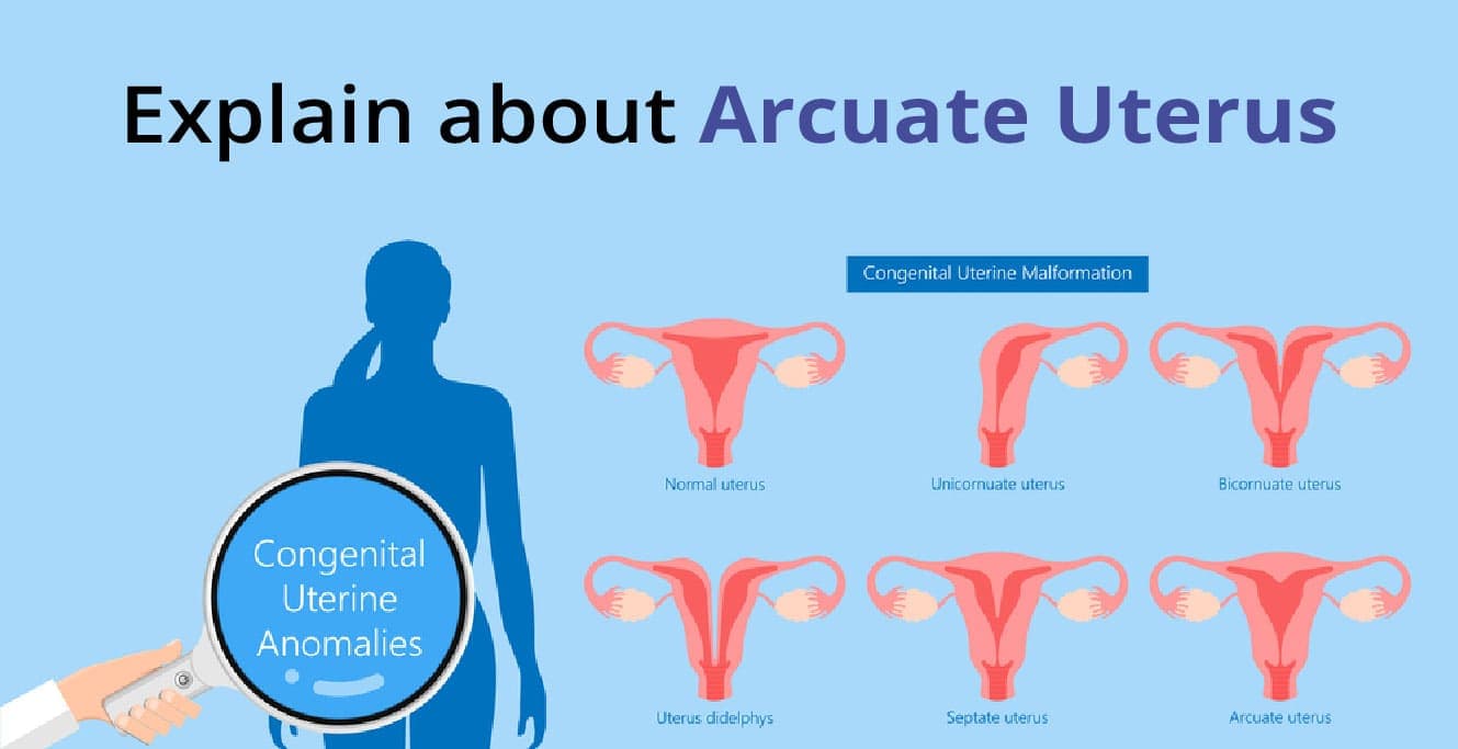 Arcuate Uterus (Heart-Shaped Uterus) - Causes, Symptoms Treatment