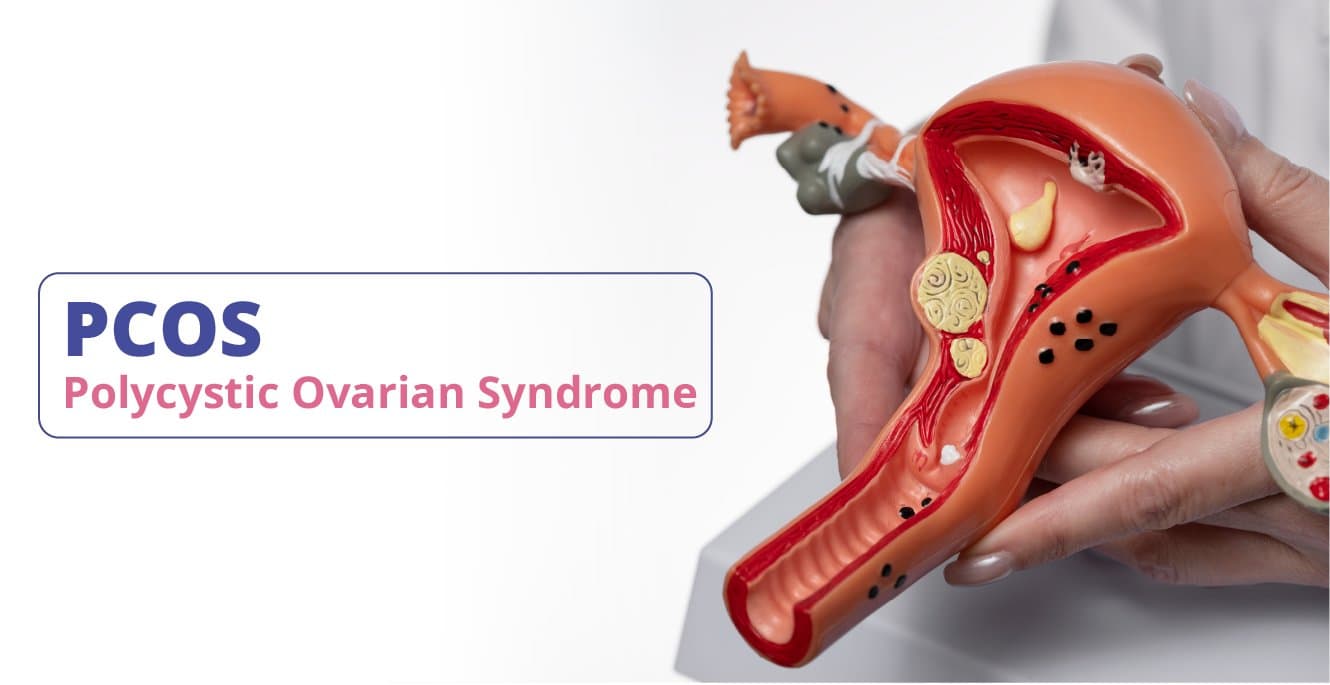 What are 4 Types of PCOS? Causes, Symptoms and Treatment | Birla ...