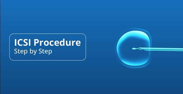 ICSI (Intracytoplasmic Sperm Injection): Step-by-Step Procedure