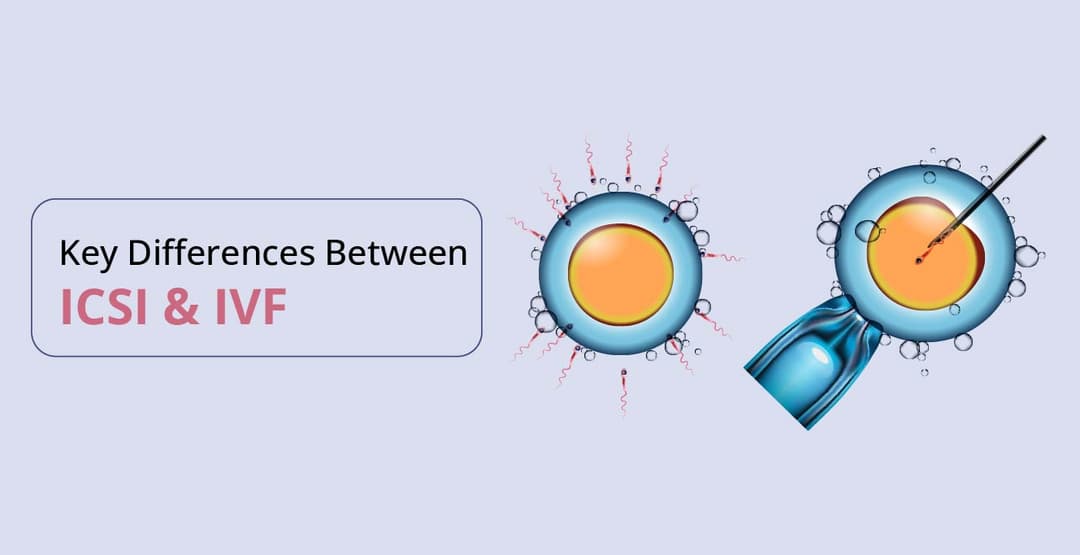 IVF vs ICSI: Difference Between IVF and ICSI Treatments