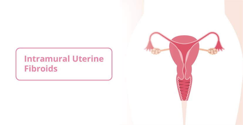 Intramural Uterine Fibroids: Causes, Symptoms & Treatment