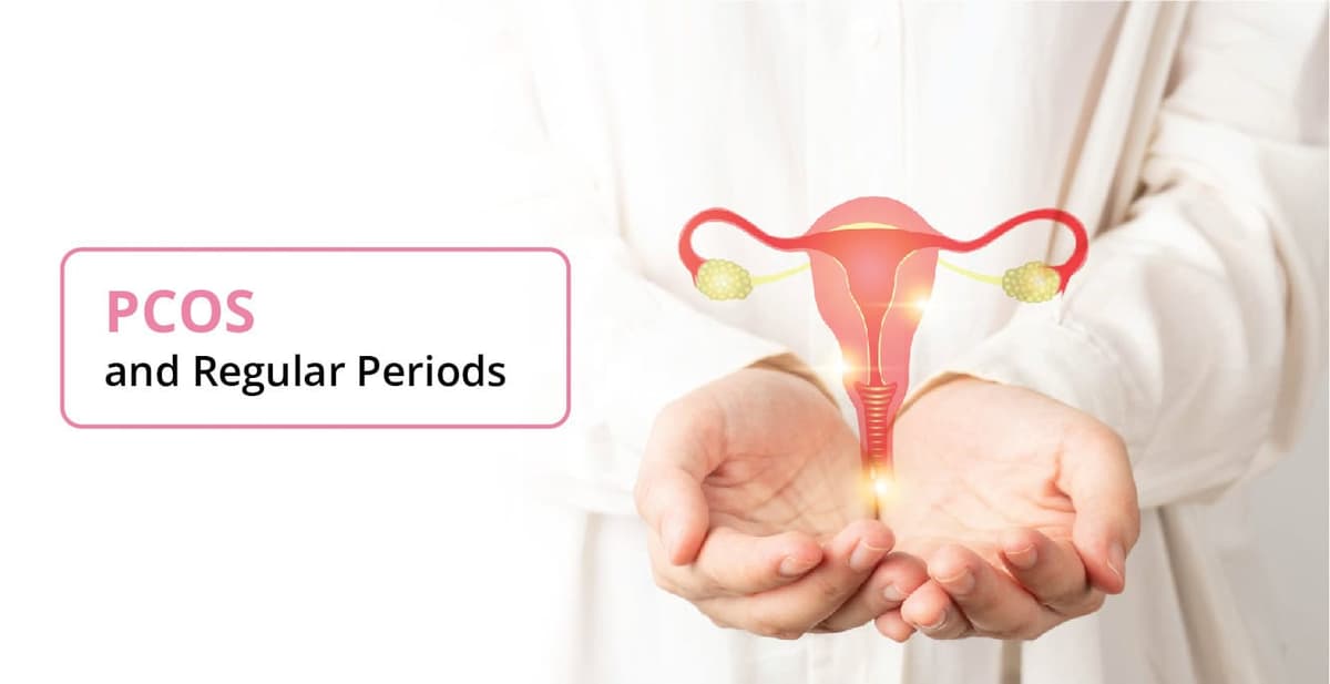 PCOS and Regular Periods: Understanding Diagnosis and Treatment
